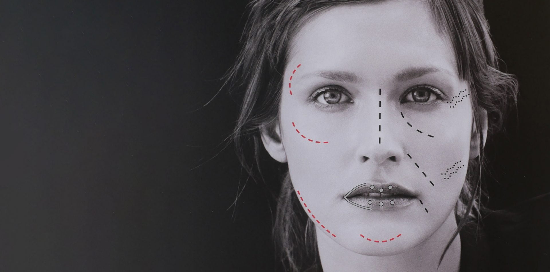 Wypełnianie Doliny Łez Londyn - Klinika Eskulap